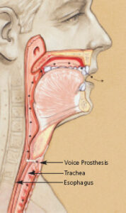 Blom-singer Voice Prosthesis – Shreyaas Health Care
